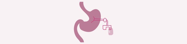 LIFT (Ligation Intersphincteric Fistula) | Clinique Michel Gagner