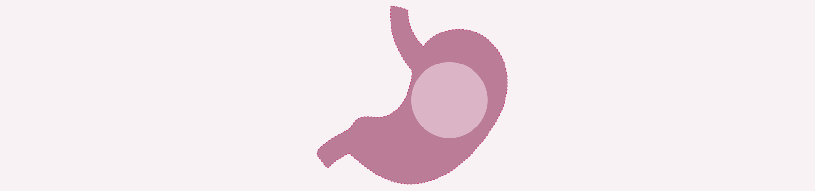 Nissen Fundoplication (GERD Surgery) Montreal, QC | Clinique Michel Gagner